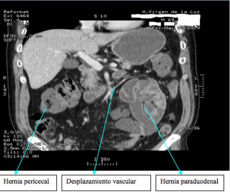Malrotación intestinal en adultos - Academia ACAD