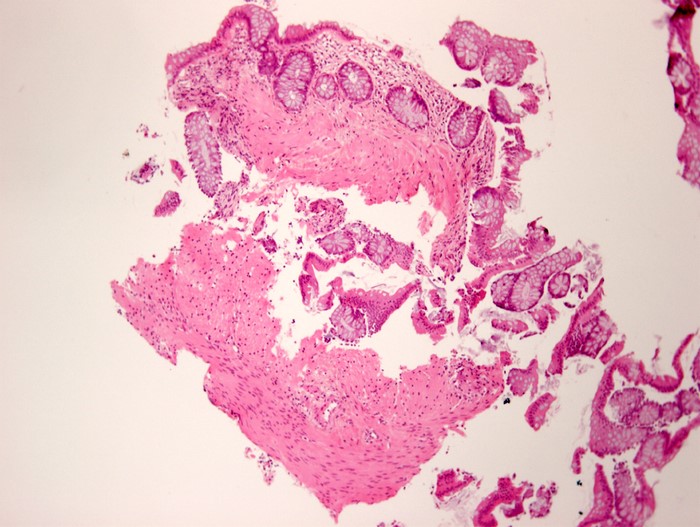 Perforación colónica con la toma de biopsias en la colitis ulcerosa de ...