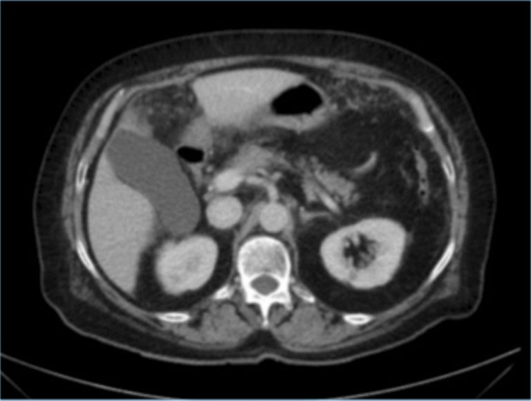 ADENOCARCINOMA PAPILAR SEROSO PRIMARIO DEL EPIPLÓN MAYOR: “OMENTAL CAKE ...
